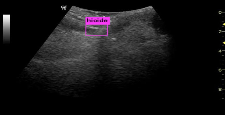 Localização do Hióide em Ultrassom – ARIA